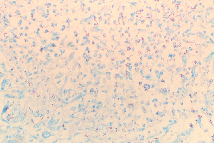 How do histologists diagnose tuberculosis? | Histology Blog