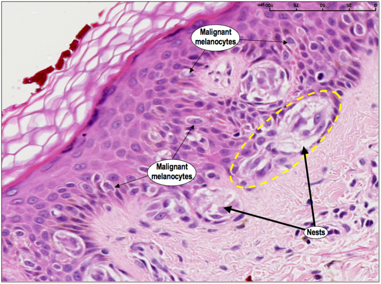 HistoQuarterly: SUPERFICIAL SPREADING MALIGNANT MELANOMA | Histology Blog