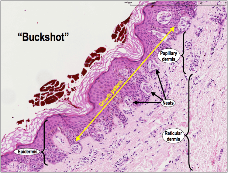 HistoQuarterly: SUPERFICIAL SPREADING MALIGNANT MELANOMA | Histology Blog