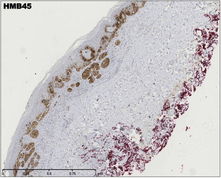 HistoQuarterly: SUPERFICIAL SPREADING MALIGNANT MELANOMA | Histology Blog