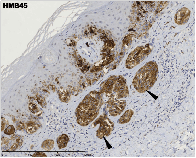 HistoQuarterly: SUPERFICIAL SPREADING MALIGNANT MELANOMA | Histology Blog