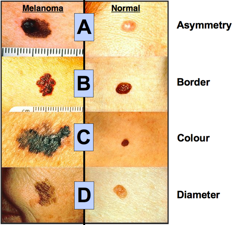 HistoQuarterly: SUPERFICIAL SPREADING MALIGNANT MELANOMA | Histology Blog
