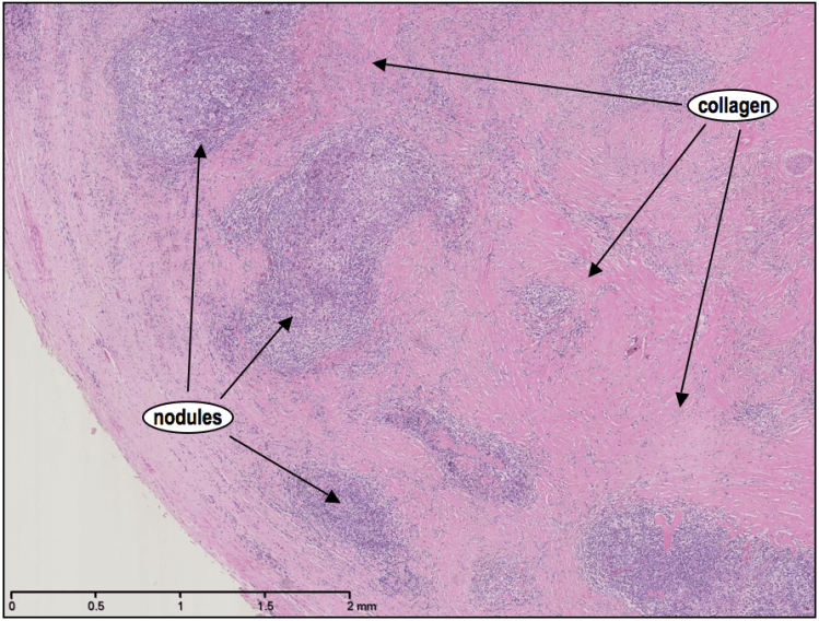 HistoQuarterly: NODULAR SCLEROSING HODGKIN LYMPHOMA | Histology Blog
