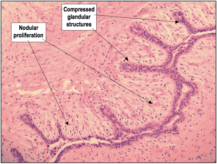 HistoQuarterly: FIBROADENOMA | Histology Blog