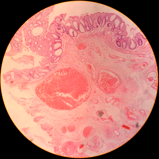 HistoQuarterly: HAEMORRHOIDS | Histology Blog