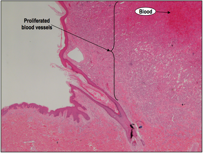 HistoQuarterly: PYOGENIC GRANULOMA | Histology Blog
