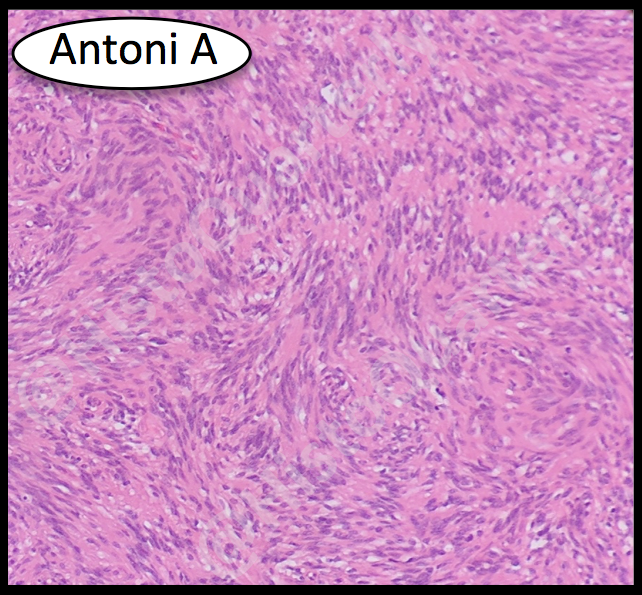 HistoQuarterly: SCHWANNOMA | Histology Blog