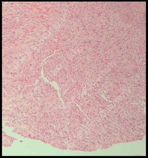 HistoQuarterly: SCHWANNOMA | Histology Blog